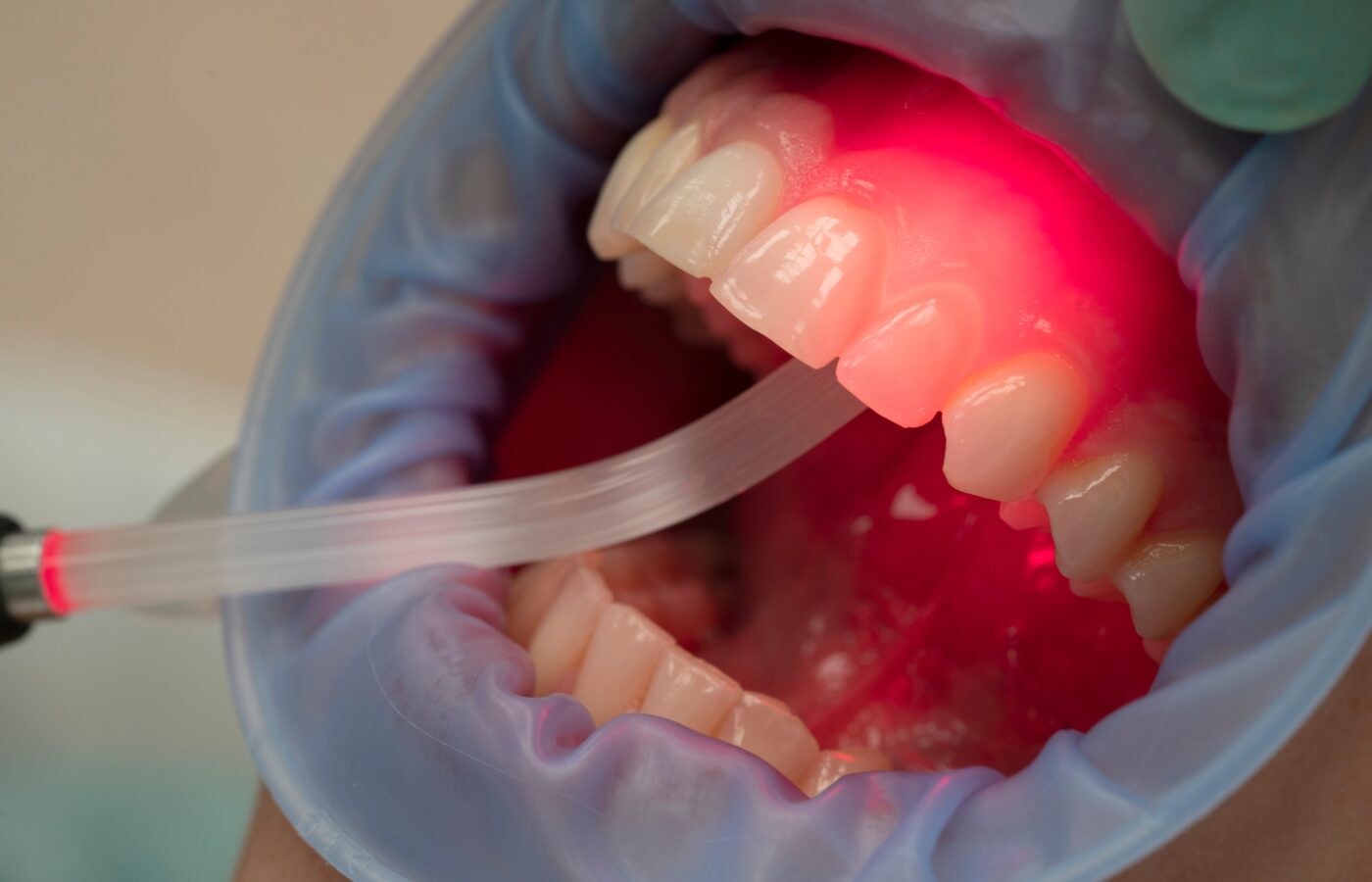 Photobiomodulation Therapy in Dentistry: A Biological & Integrative ...
