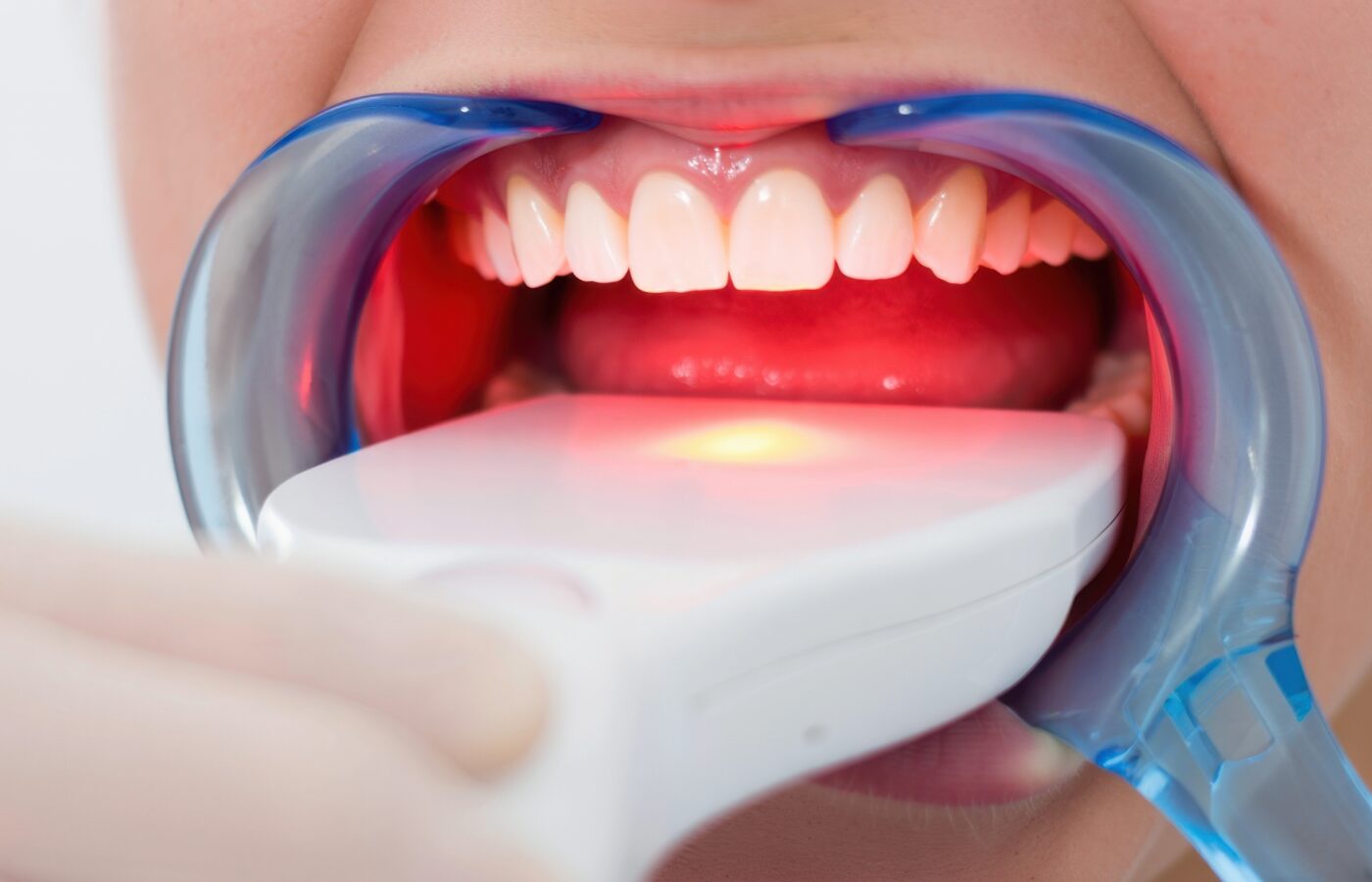 Photobiomodulation in Dentistry: Healing at the Speed of Light - Santa ...
